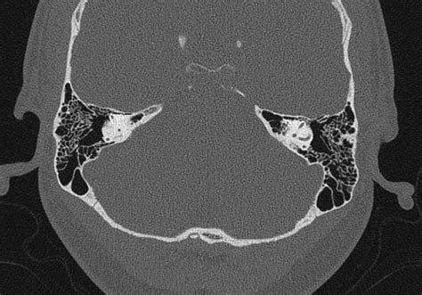 Ear Anatomy Ct Scan At Lauren Gopinko Blog