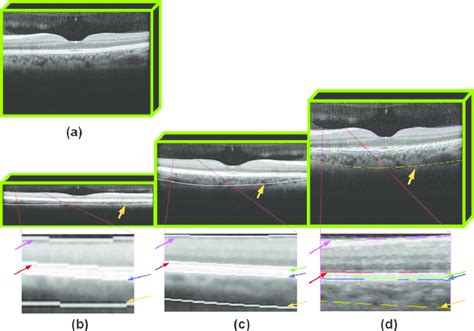 Example Illustration Of The Multistage Layer Segmentation In A B Scan