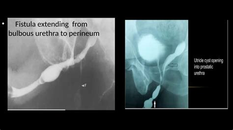 Anterior Urethrogramretrograde Urethrogrampptx