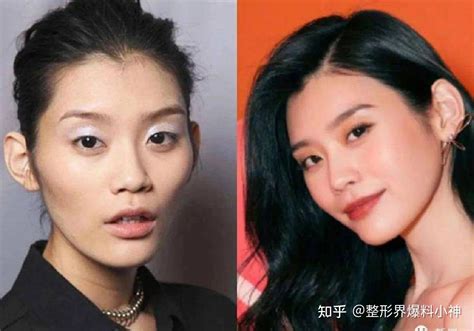吸腮 面部结构凹陷分析 知乎