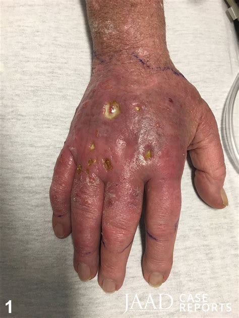 Cellulitis Hand Cellulitis Treatment And When To Worry