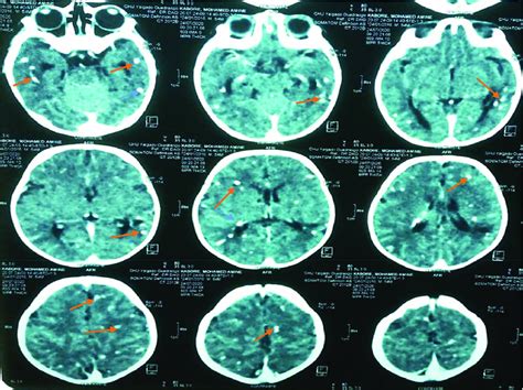 Bs Cerebral Computed Tomography Displaying Multiple Disseminated Download Scientific Diagram