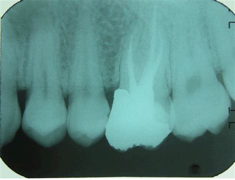 Full Text The Root Canal Treatment In Maxillary And Mandibular Molars