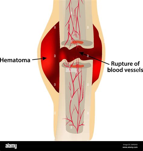 1 Stage Of Healing Bone Fracture Formation Of Callus Hematoma The Bone Fracture Infographics