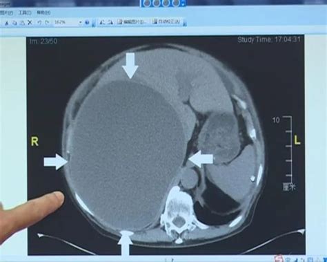 八旬老伯肚大如孕妇，随时可能“爆炸”腾讯新闻