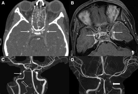 Cavernous Sinus Anatomy