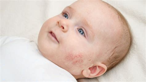 Newborn Rash Treatment In Singapore The Skin Drs