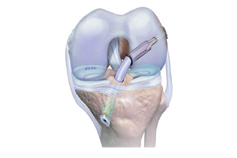 ACL PCL Ligament Reconstruction Surgery Anup Institute Of Orthopaedics Rehabilitation