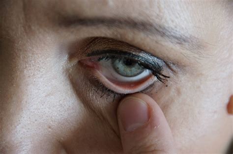 White Dot On The Inside Of The Lower Eyelid After Photos Inside Rophthalmology