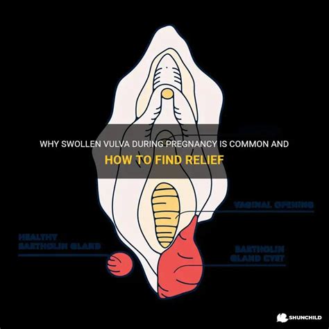 Why Swollen Vulva During Pregnancy Is Common And How To Find Relief