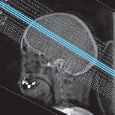 Cranial CT Normal Findings Radiology Key