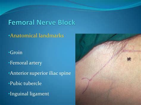 Ppt Peripheral Nerve Blocks Using Nerve Stimulator Powerpoint