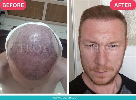 Fue 비절개 모발이식 Troy Hair