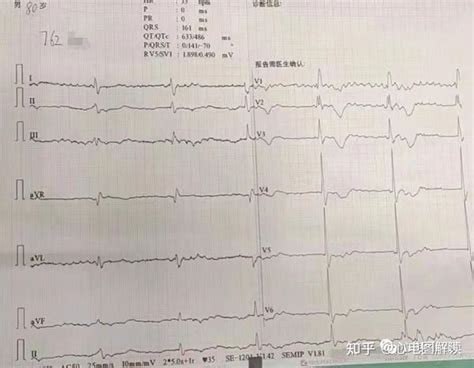 心房颤动合并三度房室传导阻滞 知乎
