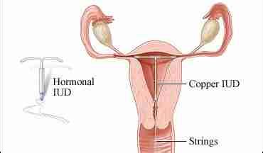 How The IUD Is Placed Gynecology Guru