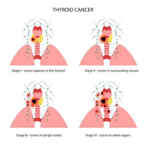 Premium Vector Thyroid Cancer Stages