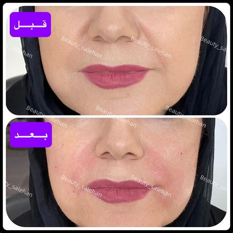 خطوط خنده، نشان شادی و زندگی‌اند، اما چرا باید این خطوط به نشانه‌ای از