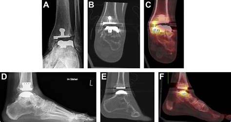 Spectct Of Total Ankle Arthroplasty Foot And Ankle Clinics