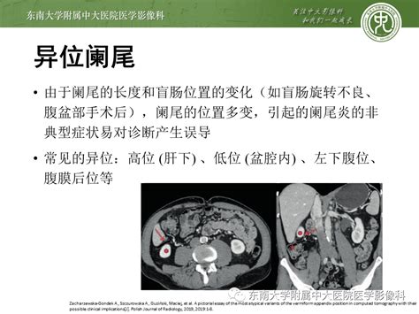 阑尾炎详细ct影像表现解读医学界 助力医生临床决策和职业成长