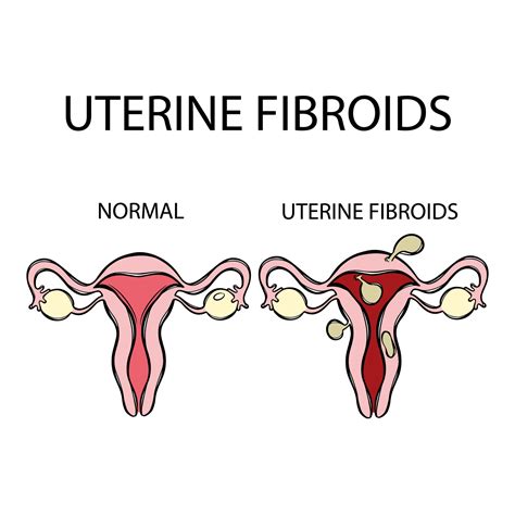 Uterine Fibroids Vs Normal Female Reproductive Education Set 20433028 Vector Art At Vecteezy
