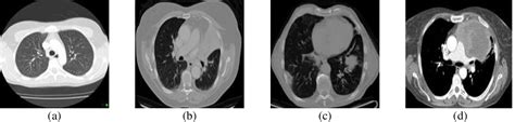 Figure 1 From Enhanced Convolutional Neural Network For Non Small Cell Lung Cancer