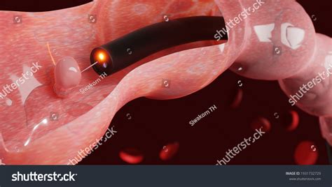 Colon Polyp Removal Endoscope Inside Colonoscopy Stock Illustration