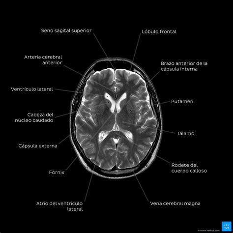 Rm Cerebral Interpretación Paso A Paso Kenhub