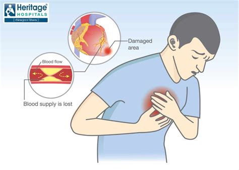 What Causes Cardiac Arrest