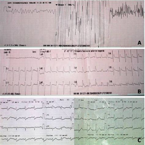 Evolution Of Patients Cardiac Monitorization And 12 Lead Ecgs A
