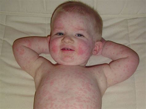 Slapped Cheek Syndrome All You Need To Know