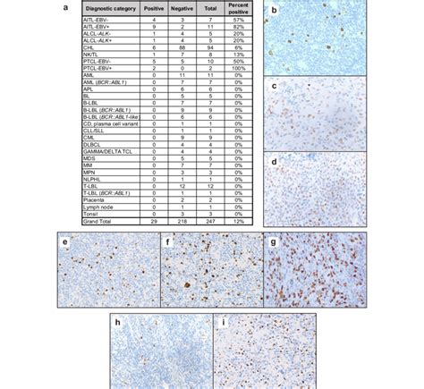 Satb2 Protein Immunoreactivity In Hematolymphoid Neoplasms Aitl Ebv