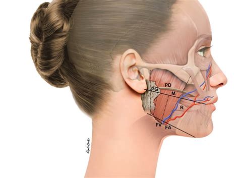 Unilateral Masseter Hypertrophy