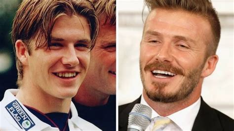 David Beckham Blepharoplasty Facts And Expert Insights