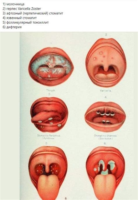 How To Cure Angular Cheilitis Self Care And Treatments Artofit