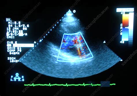 Echocardiogram Stock Image P Science Photo Library