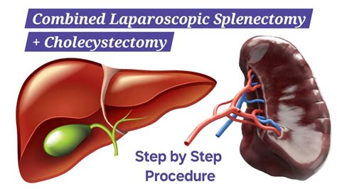 Splenectomy Step By Step Combined Laparoscopic Splenectomy