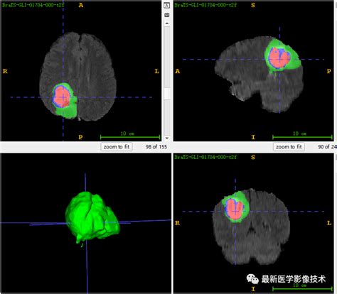 Brats2023 Gli——brats2023成人胶质瘤分割挑战赛 腾讯云开发者社区 腾讯云