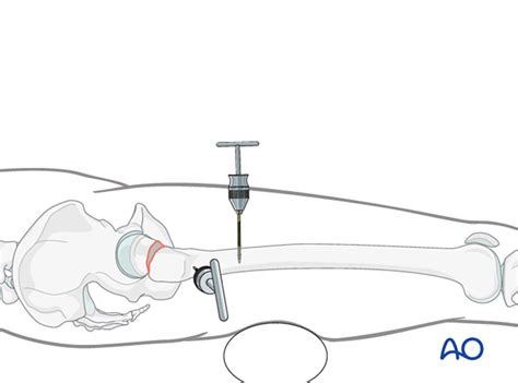 Percutaneous Reduction Techniques Femoral Neck Fractures