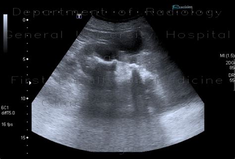 Nephrolithiasis Ultrasound