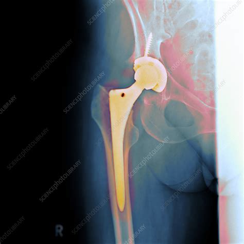 Total Hip Replacement X Ray Stock Image M6000387 Science Photo