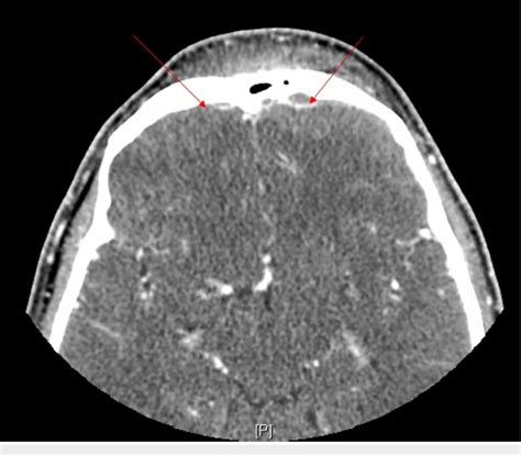 CT Head With Contrast Shows Swelling And Enhancement Of The Front