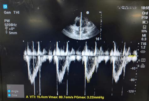 The Left Ventricular Outflow Tract Velocity Time Integral As A