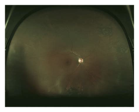 Two Hundred Degree Ultrawide Field Color Retinal Imaging Using 633 Nm Download Scientific