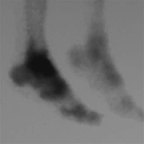 Synovial Sarcoma Foot And Ankle