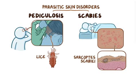 Dermnet Scabies