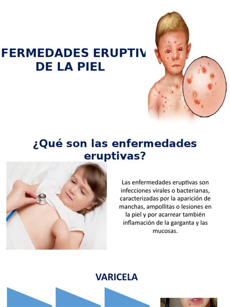 Enfermedades Eruptivas Pdf Inmunología Microbiología