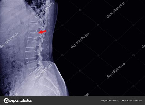 Film Ray Spine Lateral Views Showing Compression Fracture 51 Off