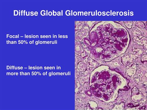 Ppt Glomerular Diseases Powerpoint Presentation Free Download Id 3216704