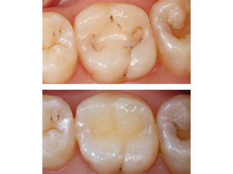 Tetric Plus Simplified Universal Composite Ivoclar