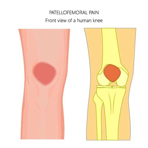 Patellofemoral Pain Syndrome Brisbane Brisbane North Clinic
